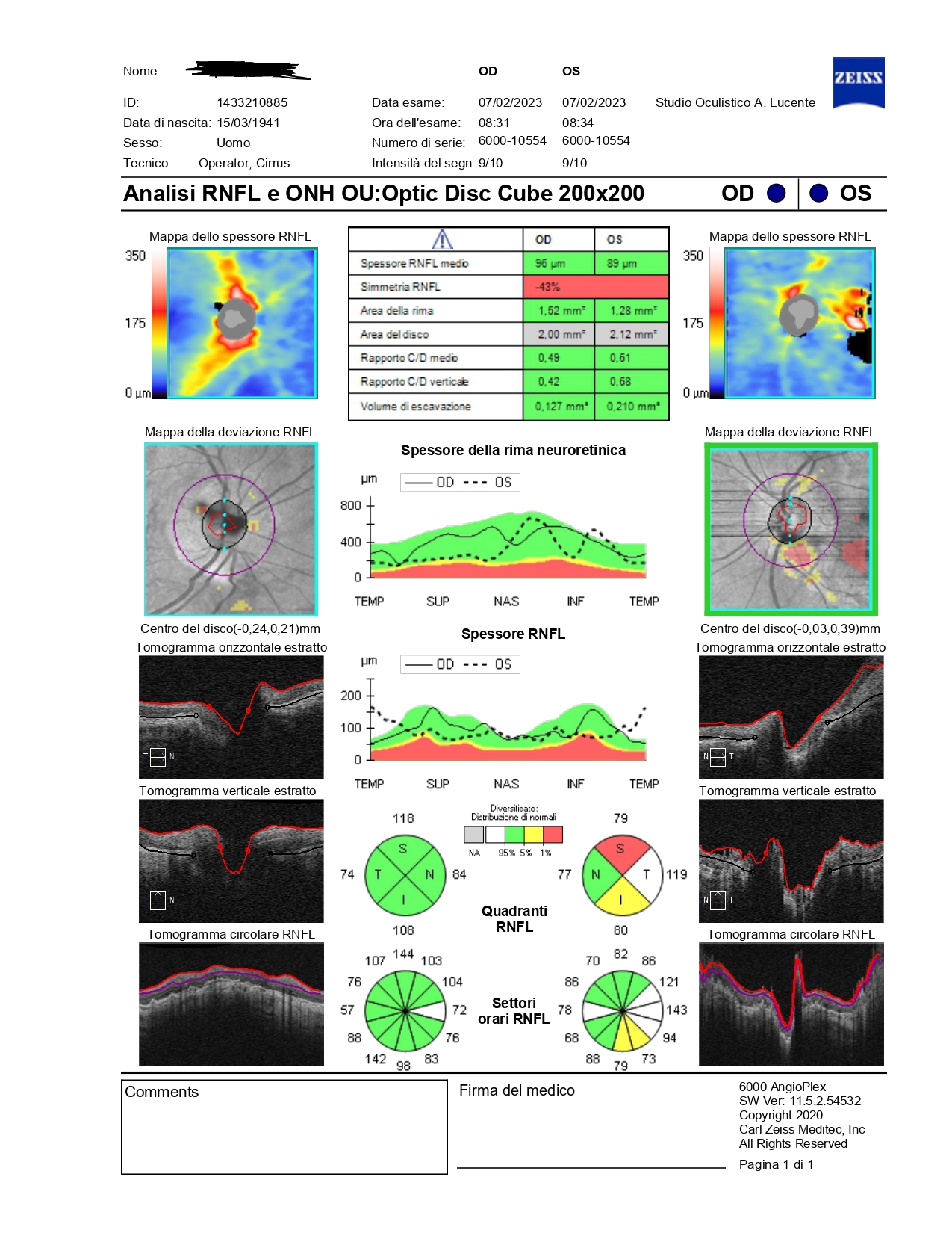 malattie degli occhi casi clinici reali :RNFL e Cellule gangliari in macula